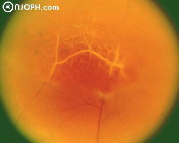Medicine Decoded: Various Lines in Ophthalmology